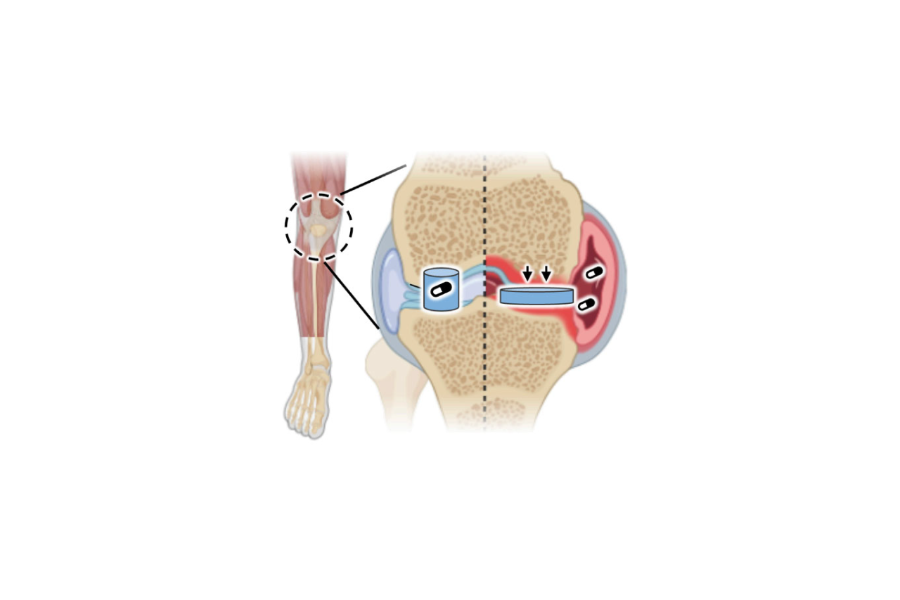 ‘Artificial cartilage’ could improve arthritis treatment – Cambridge ...